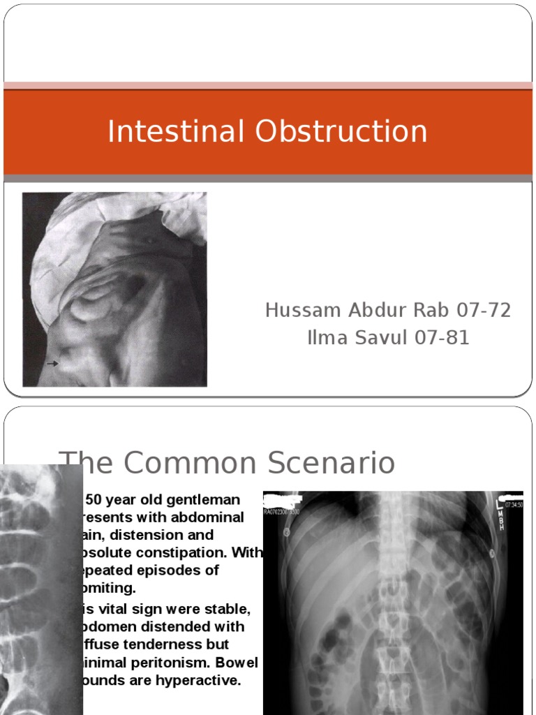 Understanding Intestinal Obstruction | PDF