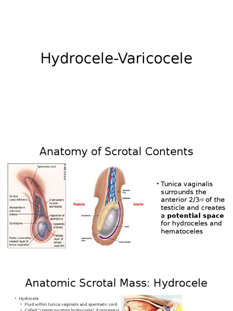 Hydrocele Varicocele Genitourinary System Diseases Medical Specialties