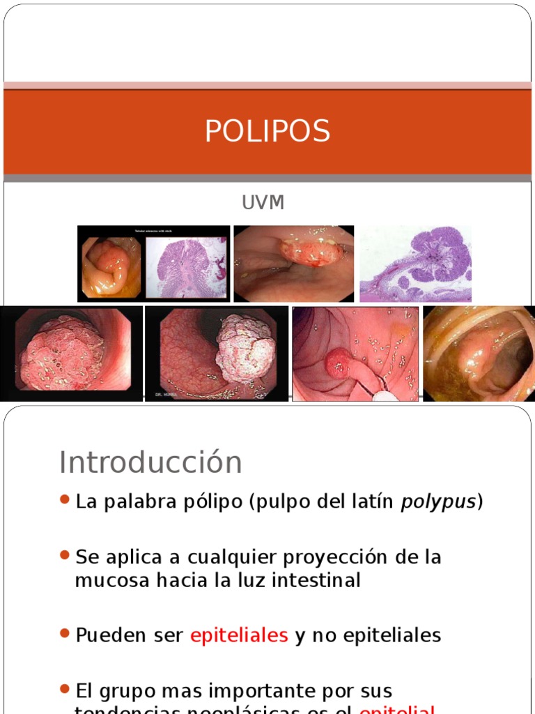 Polipos de Colón | PDF | Cáncer colonrectal | Cáncer