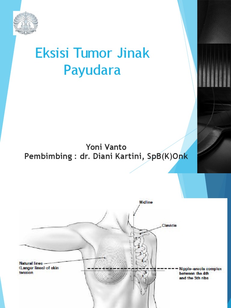 Eksisi Tumor Jinak Payudara: Panduan Lengkap | PDF
