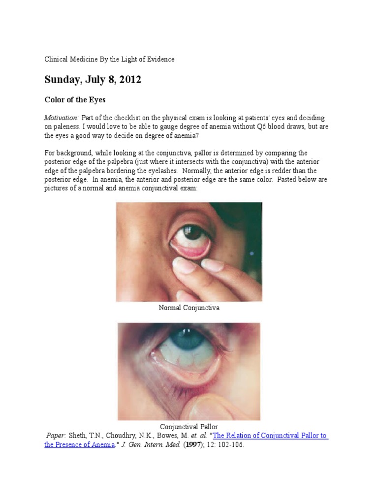 Anemia Eyes Vs Normal Eyes