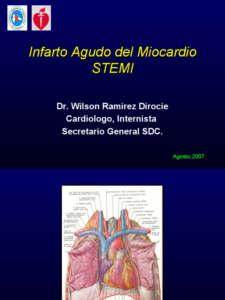 Infarto Agudo Del Miocardio Stemi | PDF | Myocardial Infarction ...