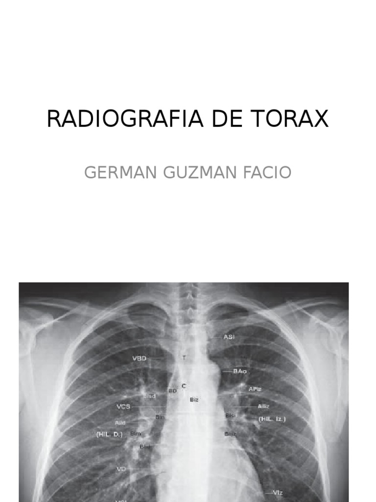 Rx de torax