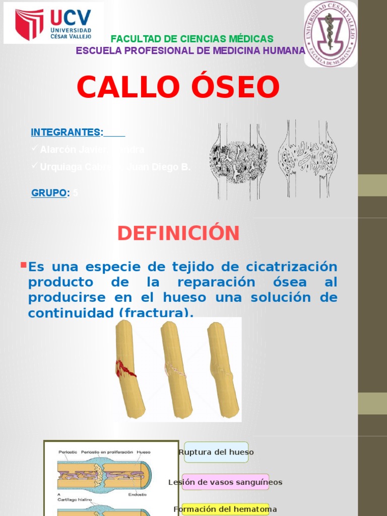 Callo Óseo: Escuela Profesional De Medicina Humana | Hueso | Inflamación