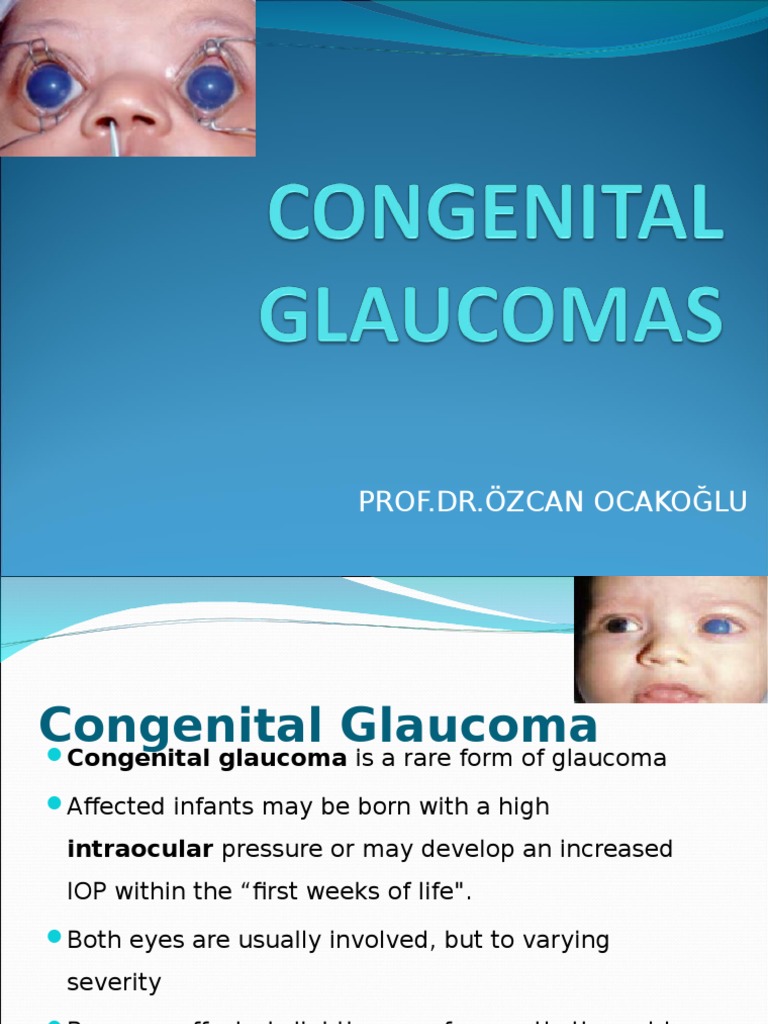 Congenital Glaucomas | PDF | Glaucoma | Ophthalmology