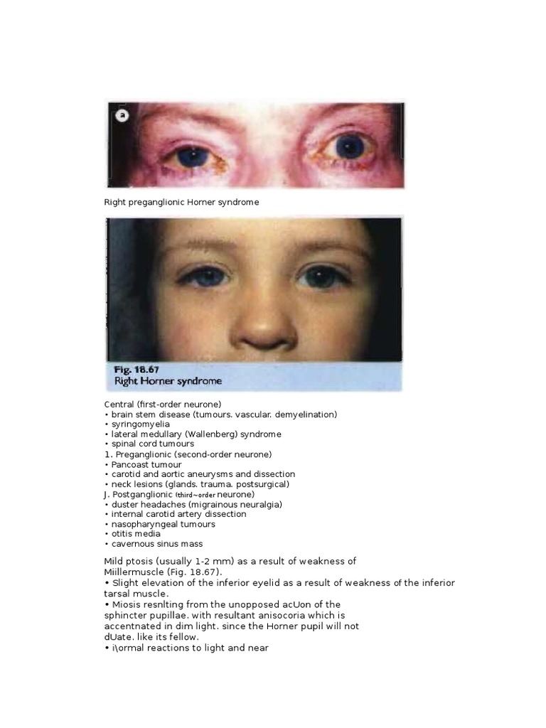 Horner SYndrome | PDF | Neurology | Human Anatomy