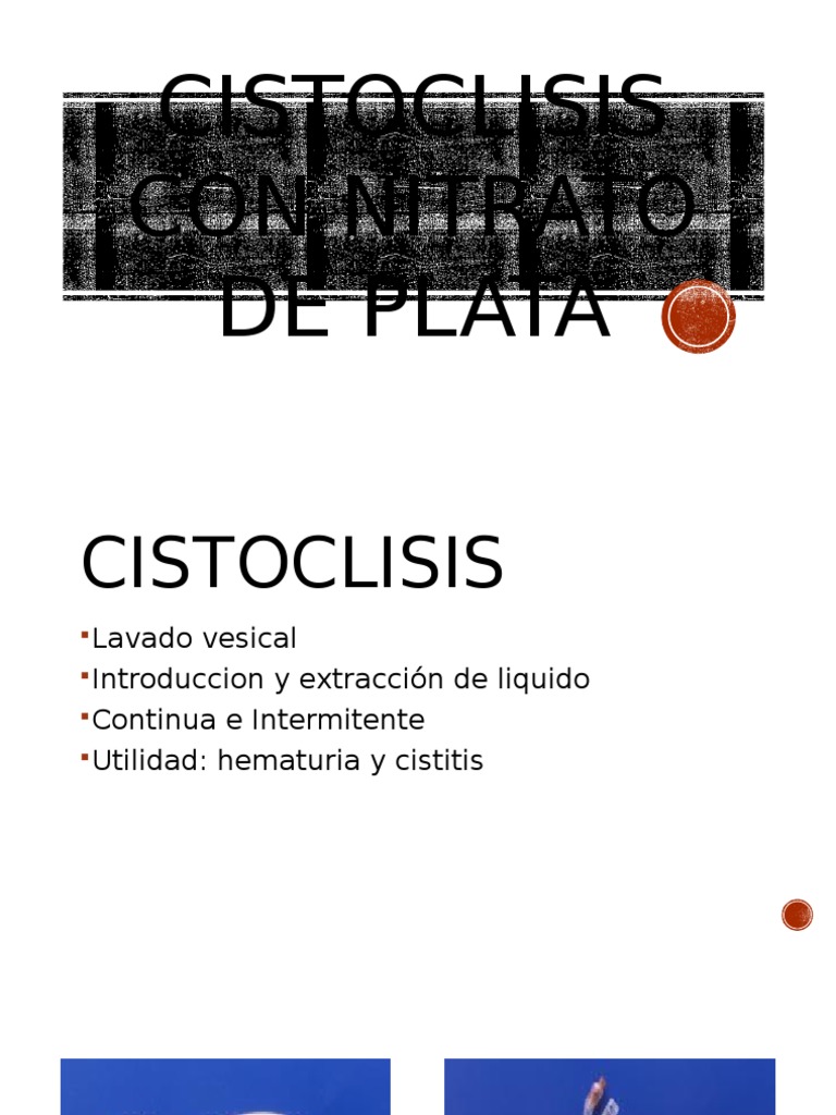 Guía sobre Cistoclisis y Nitrato de Plata | PDF | Vejiga urinaria | Orina