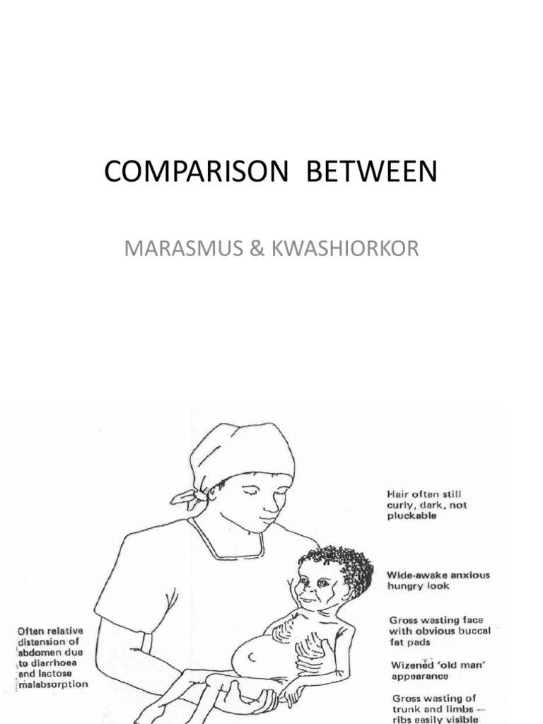 Comparison Between Marasmus & Kwashiorkor PDF | PDF | Wellness