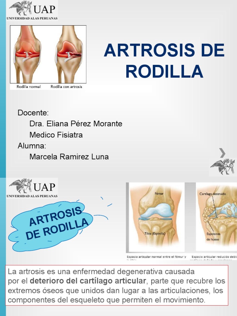 Artrosis de Rodilla | PDF | Rodilla | Osteoartritis