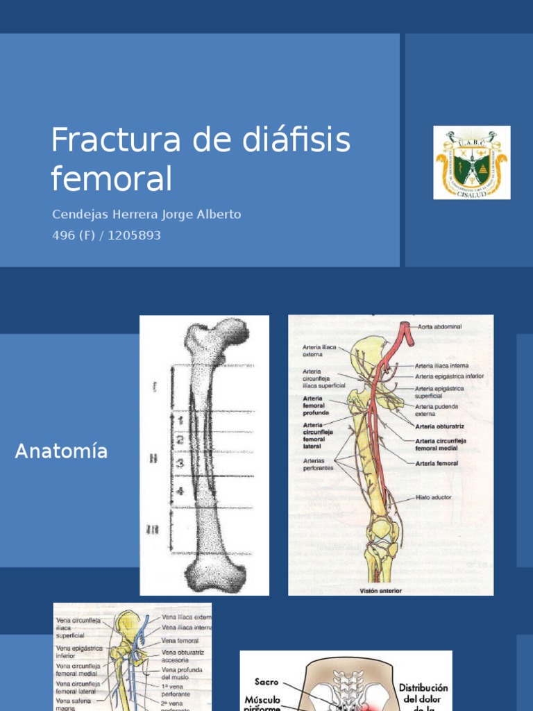 Fractura de Diáfisis Femoral | Rodilla | Anatomía humana