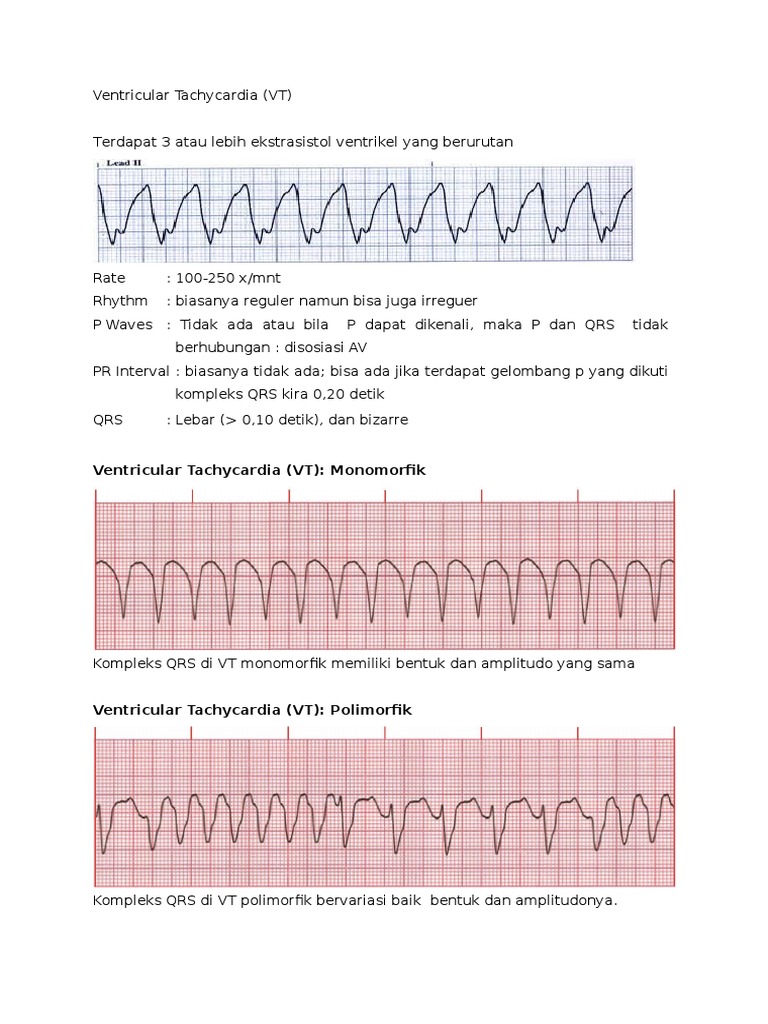 Ventricular Tachycardia (VT) : Monomorfik | PDF