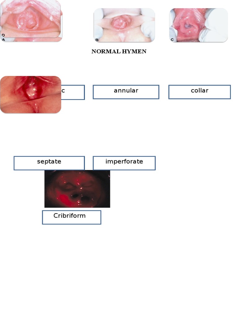 Normal Hymen | PDF