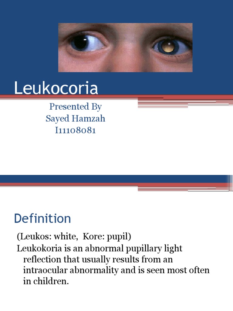 DT Leukocoria | PDF | Ophthalmology | Medical Specialties