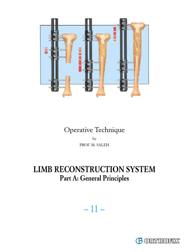 Limb Reconstruction System Overview | PDF | Screw | Hip