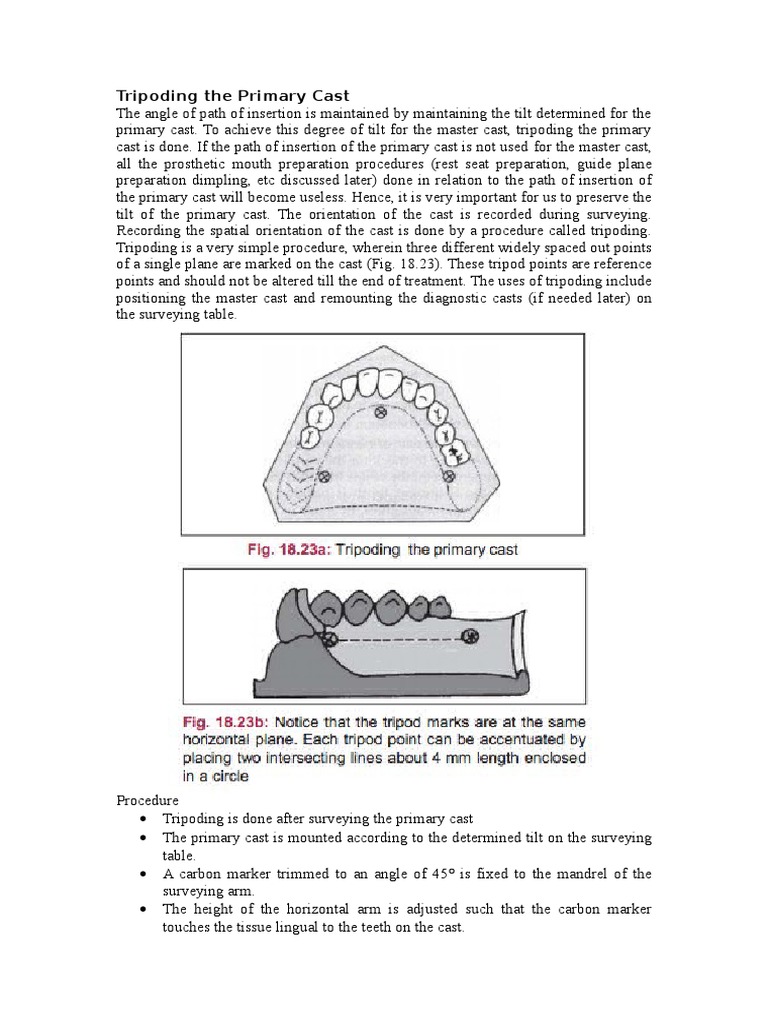 Tripoding the Primary Cast in RPD | PDF | Dentures | Tooth