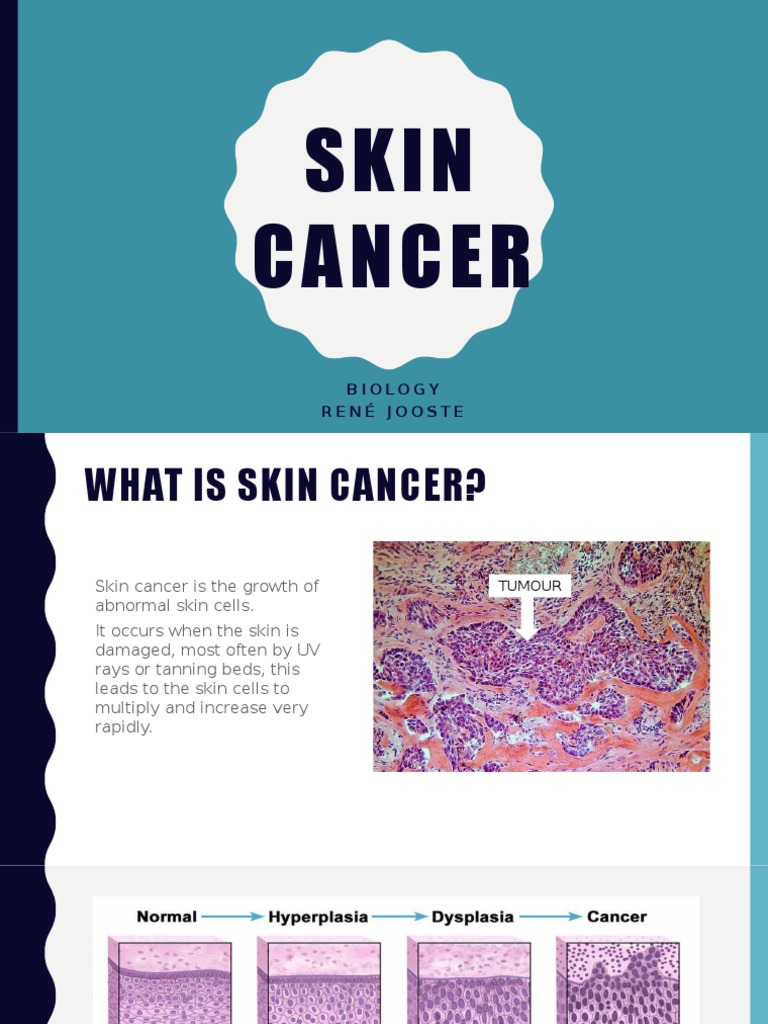 Skin Cancer | PDF | Skin Cancer | Cancer