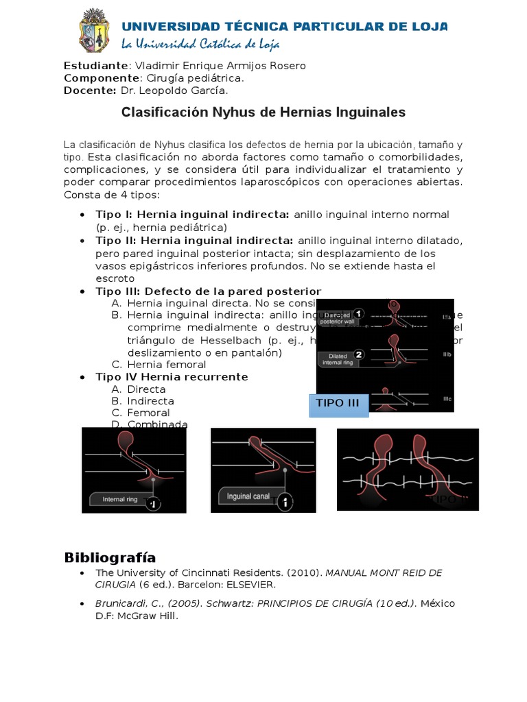 Clasificación de Hernias Inguinales Nyhus | PDF