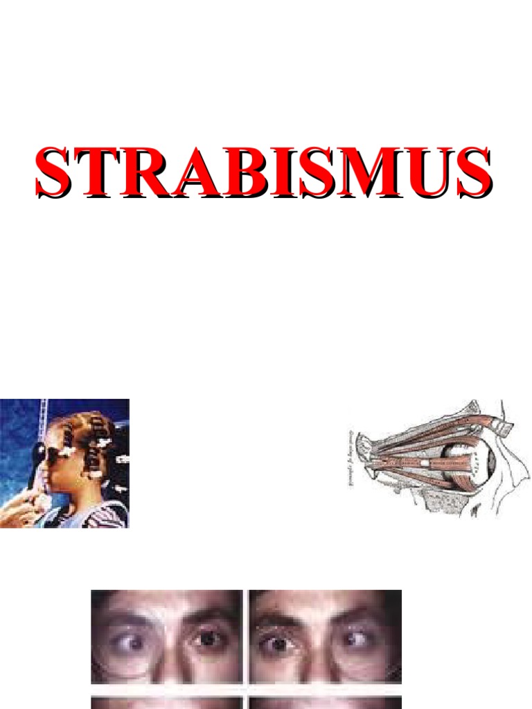 STRABISM | PDF | Ophthalmology | Light