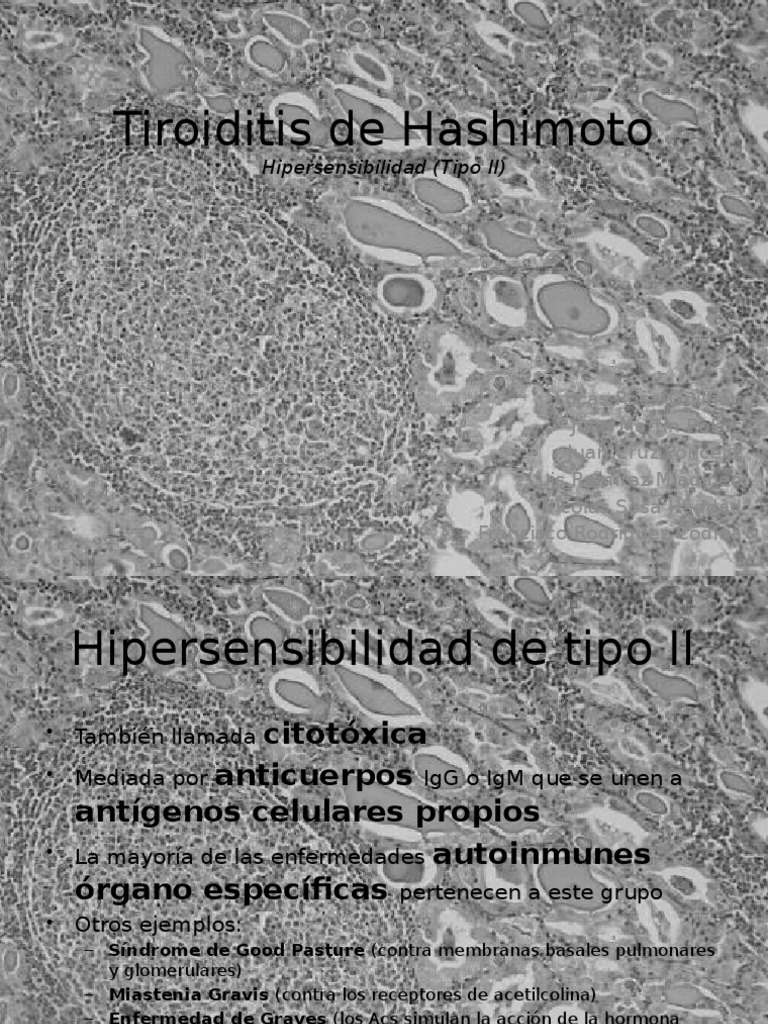 Tiroiditis de Hashimoto | Tiroides | Hipotiroidismo