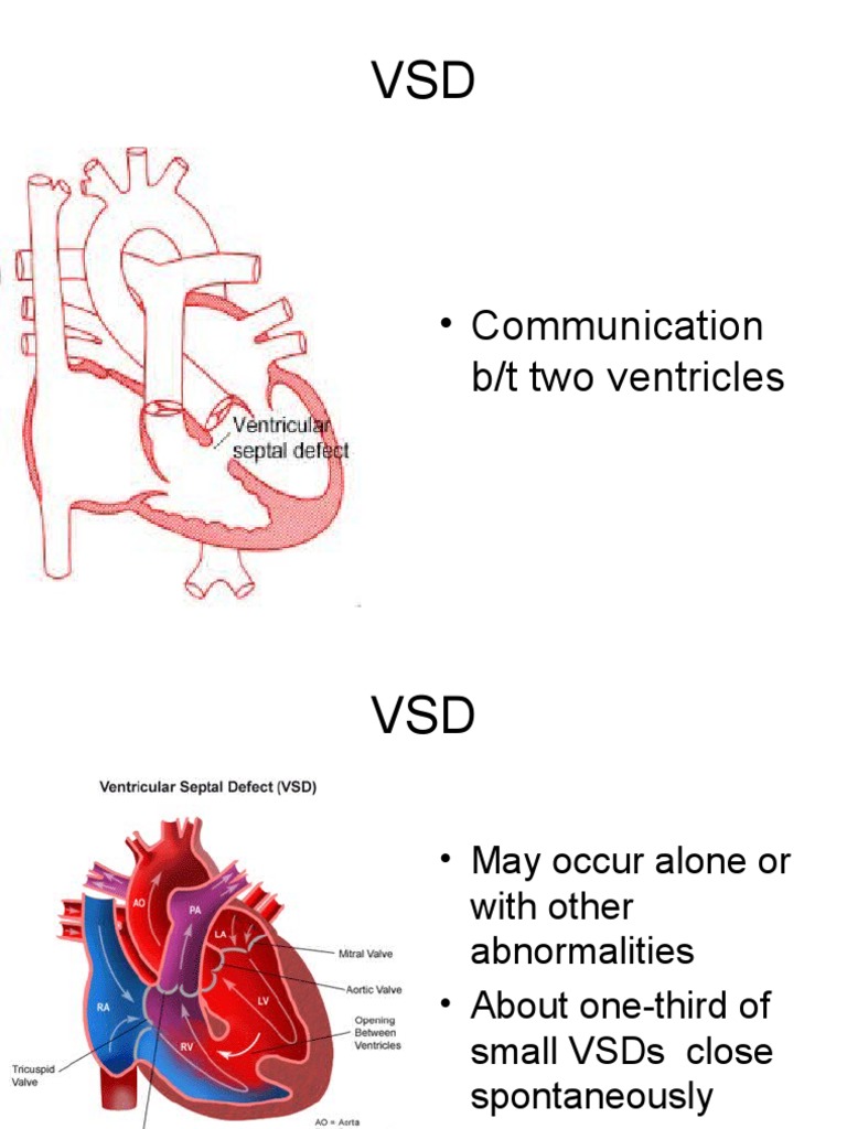 VSD | Ventricle (Heart) | Heart Failure