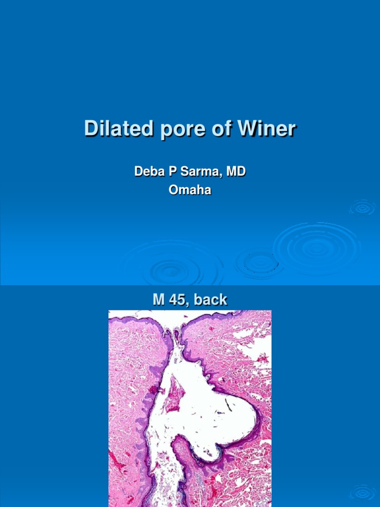 Dilated Pore of Winer | PDF | Sensory Organs | Skin