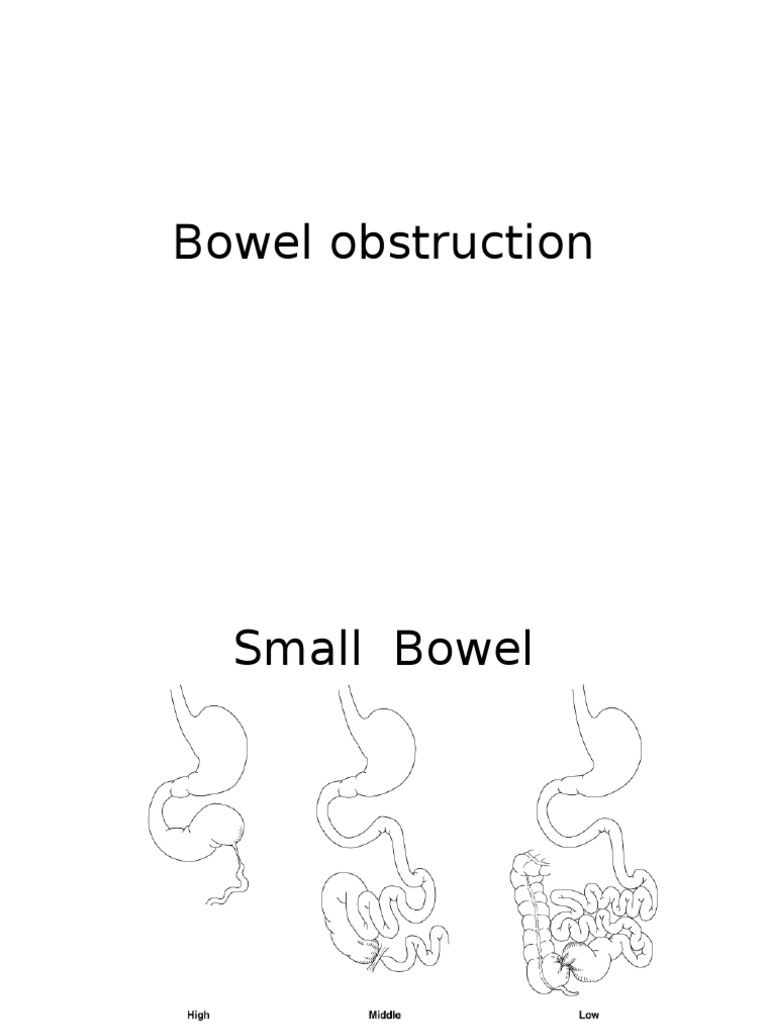 Bowel Obstruction - ppt1 | PDF | Colorectal Cancer | Large Intestine