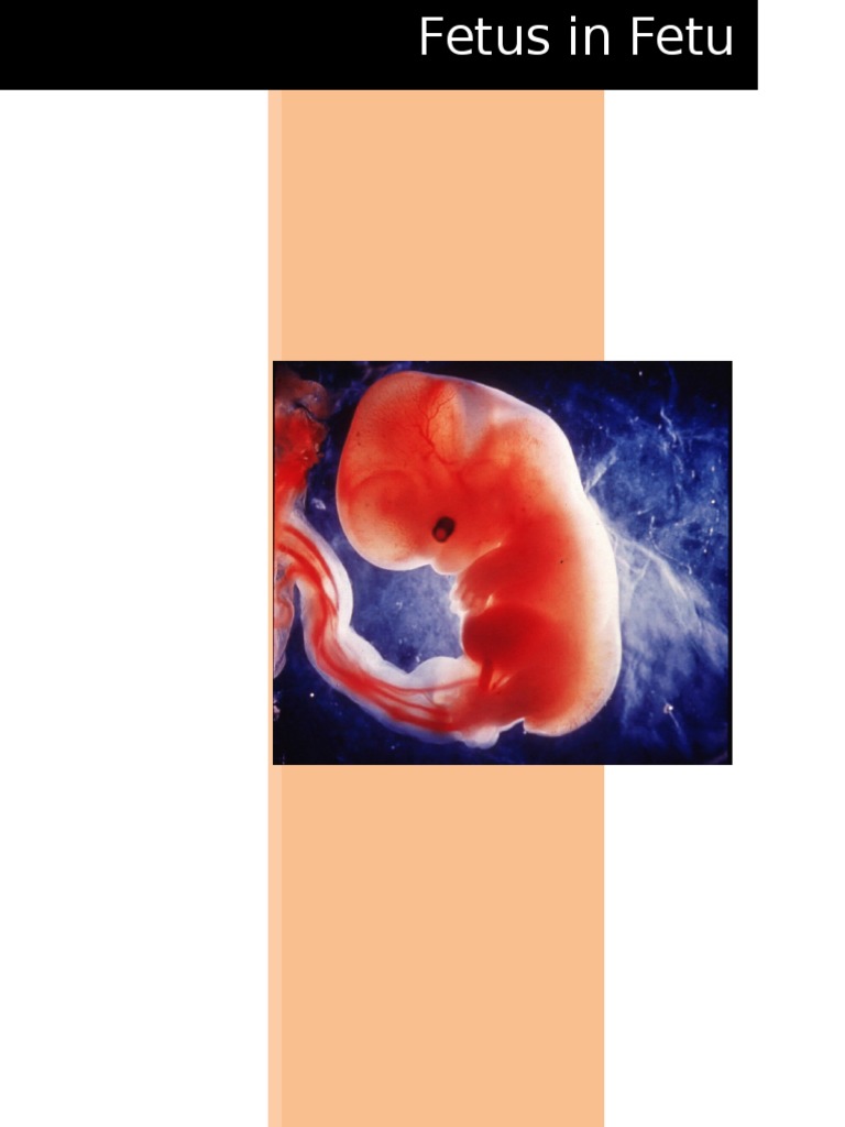 Fetus in Fetu | PDF | Gemelo | Abdomen