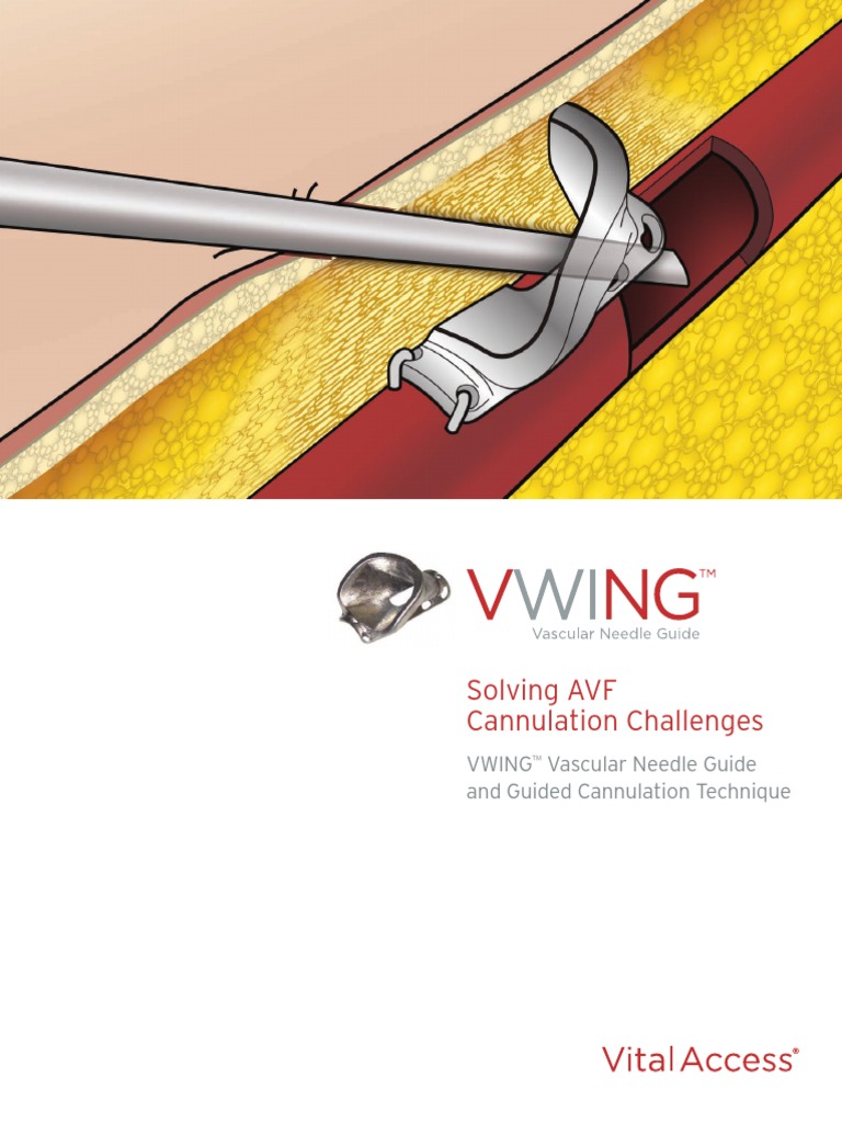 Solving AVF Cannulation Challenges | PDF | Hemodialysis | Medicine