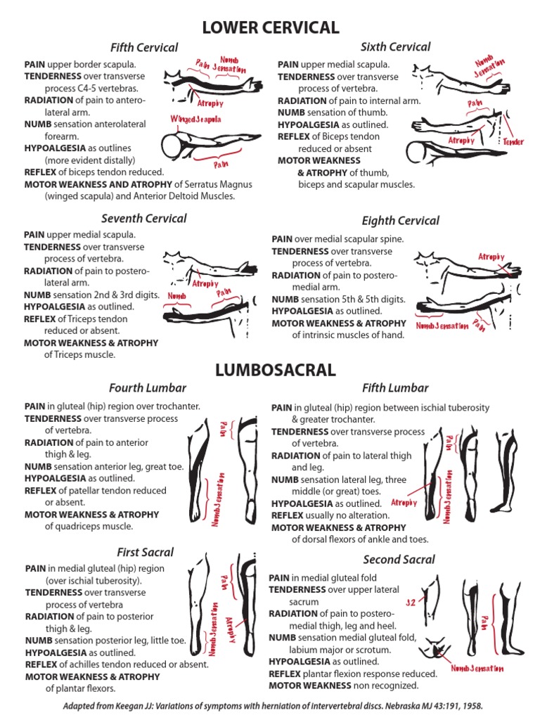 Back Radiculopathy Chart | PDF | Vertebra | Vertebral Column