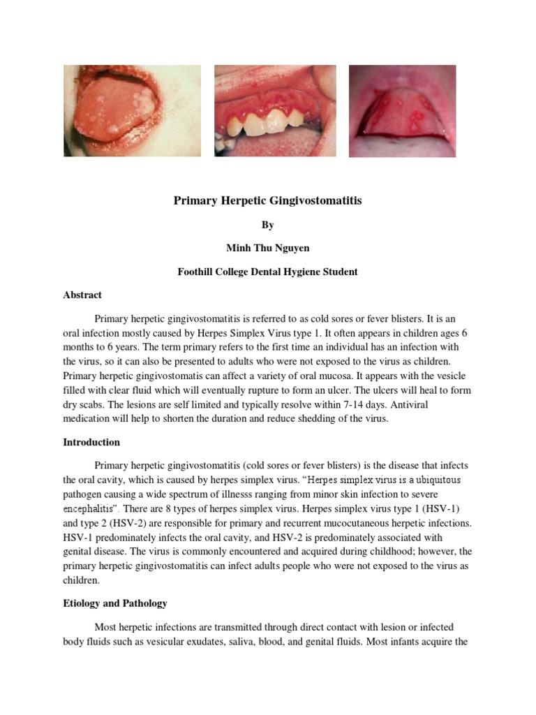 Primary Herpetic Gingivostomatitis Histology