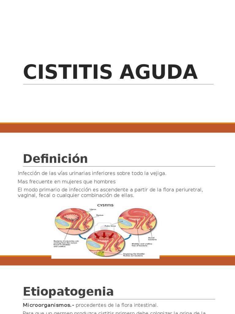 Cistitis Aguda | PDF | Infección del tracto urinario | Urología