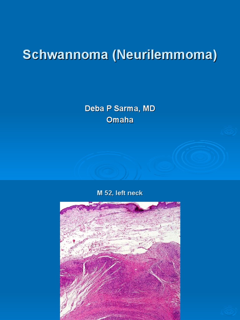 Schwannoma Pathology Overview | PDF
