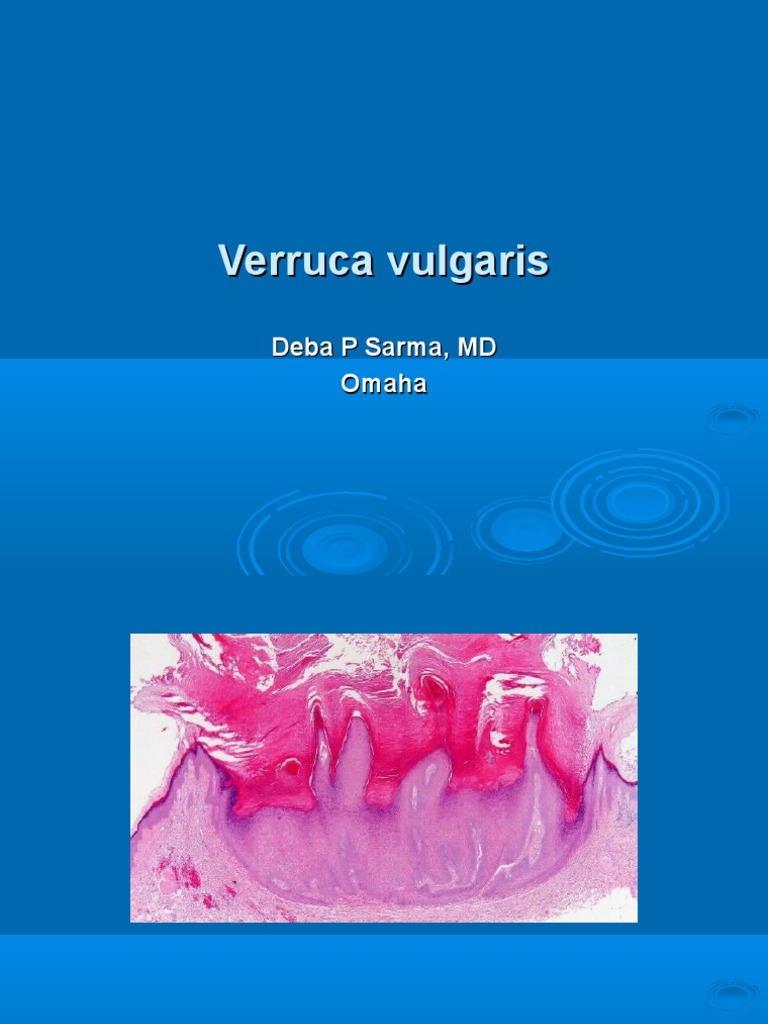 Verruca Vulgaris.