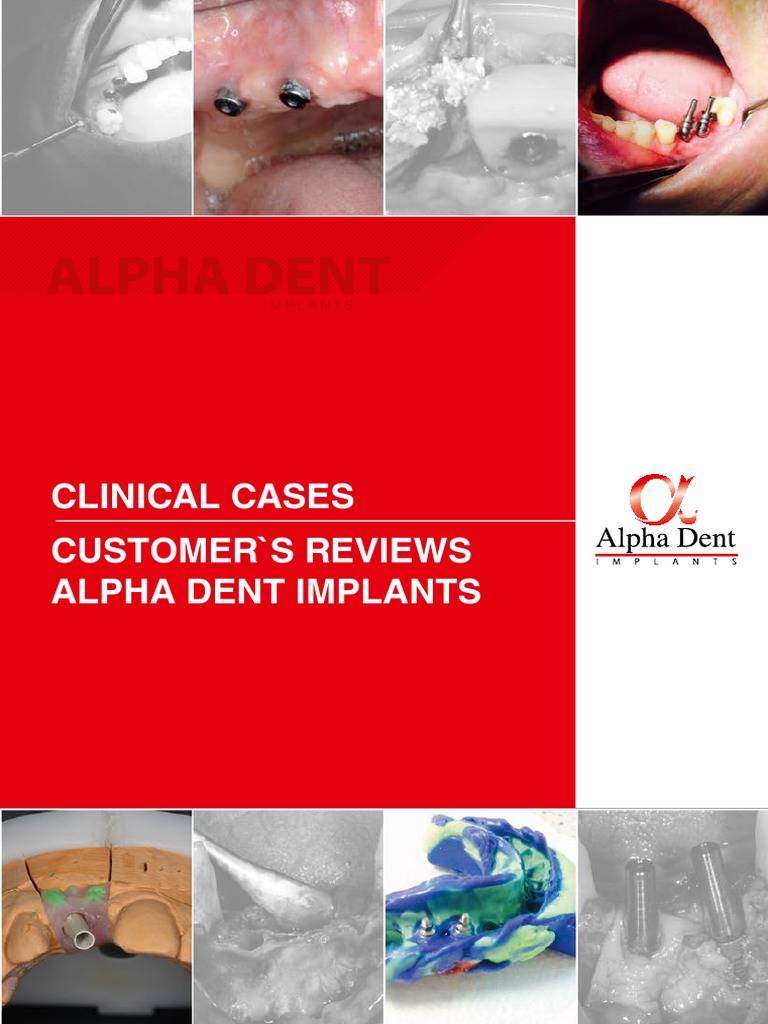 Alpha Dent Implants Online Book Customers Reviews and Clinical Cases ...