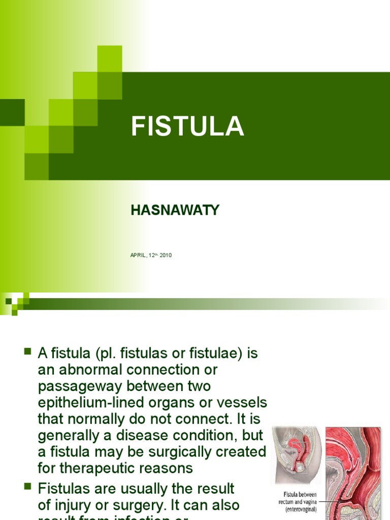 Understanding Fistulas: Causes & Treatment | PDF