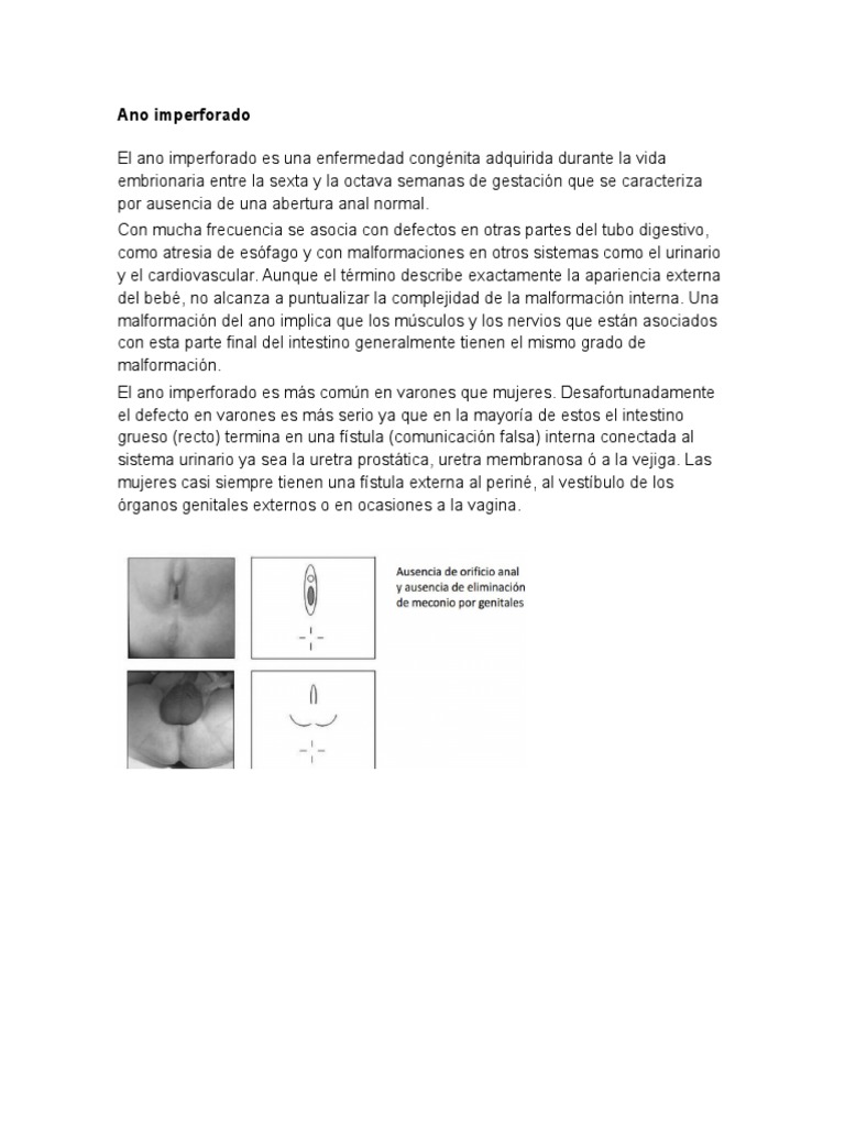 Ano Imperforado | PDF | Vagina | Abdomen