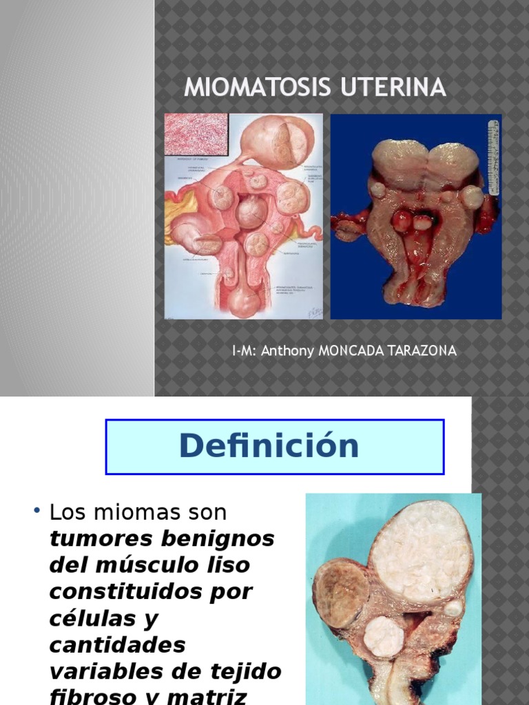Miomatosis Uterina | PDF