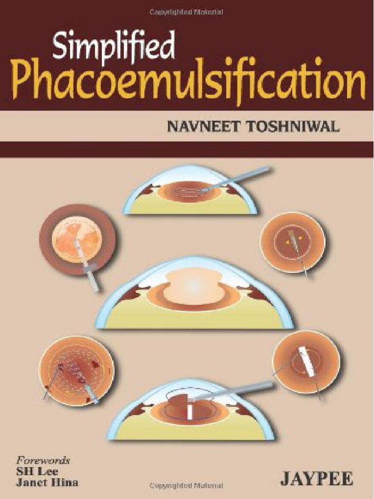 Simplified-Phacoemulsification_-_2013.pdf | Ophthalmology | Eye