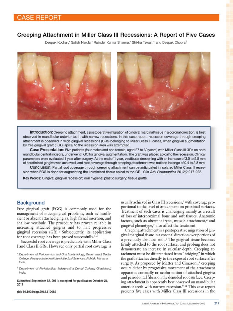 Creeping Attachment in Miller Class III Recessions | Periodoncia ...