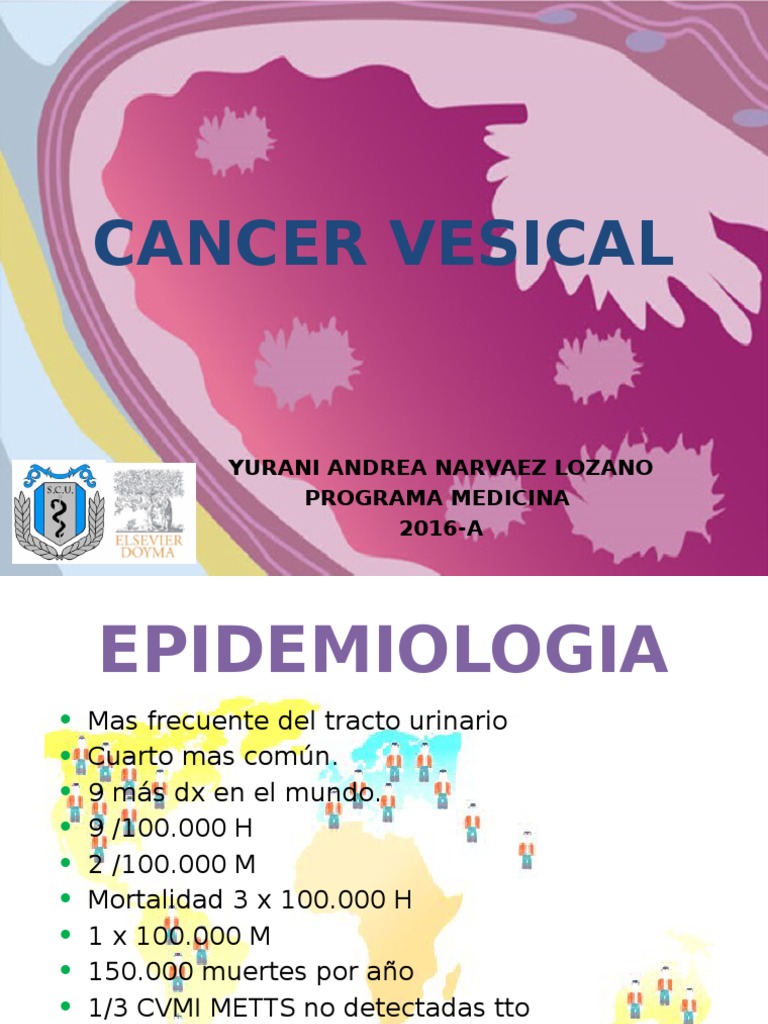 Cancer Vesical - PPTX Andrea | PDF | Especialidades Medicas | Neoplasias