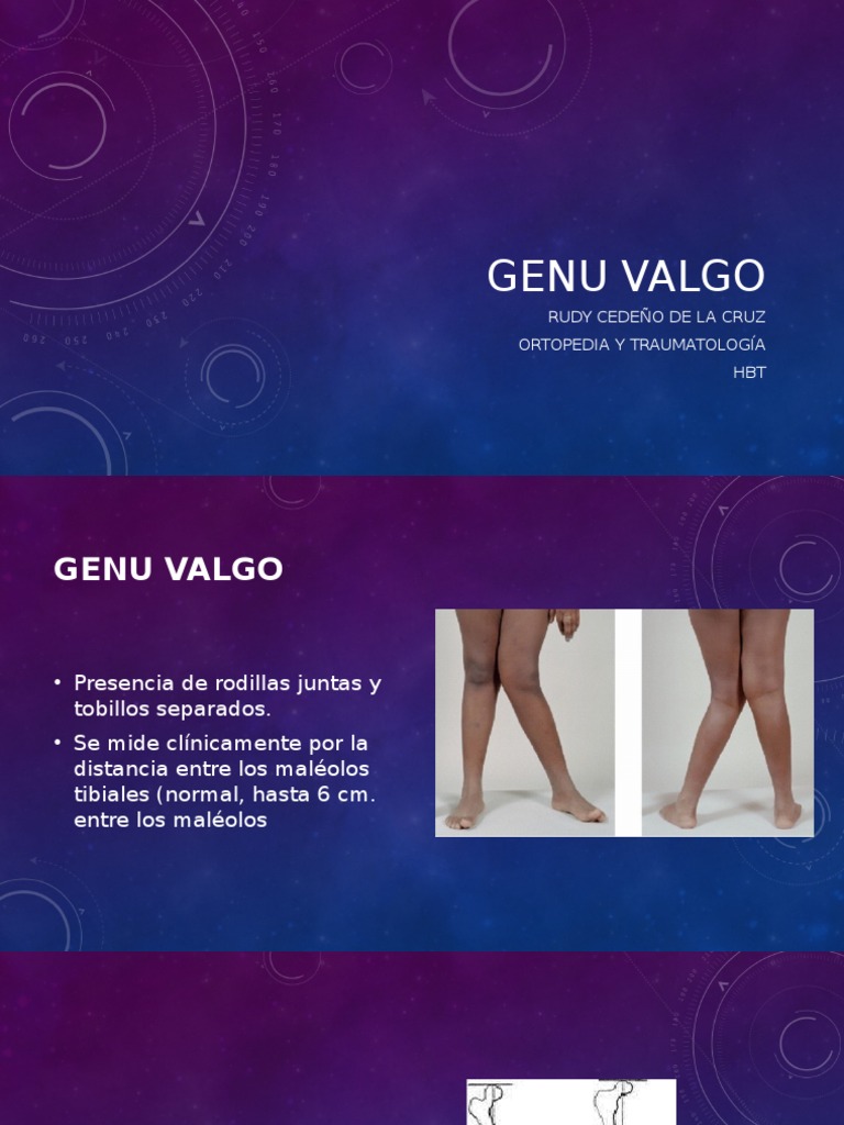 Genu Valgo | Rodilla | Pie