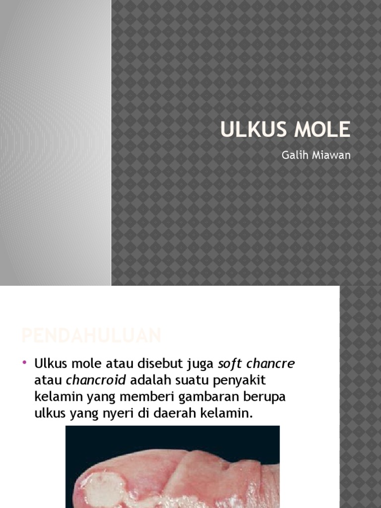 Ulkus Mole | PDF