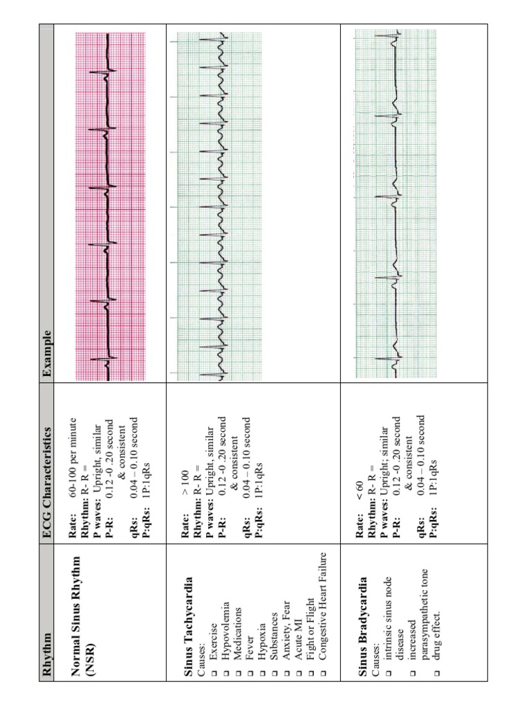 EKG Flash Cards.pdf | Electrocardiography | Heart