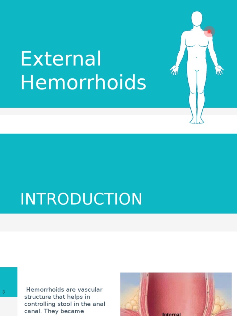 Understanding External Hemorrhoids | PDF | Hemorrhoid | Health Sciences