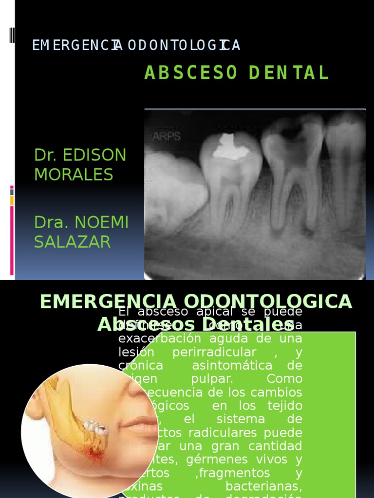 Abscesos Dentales-2015 España.pptx | Diente humano | Odontología