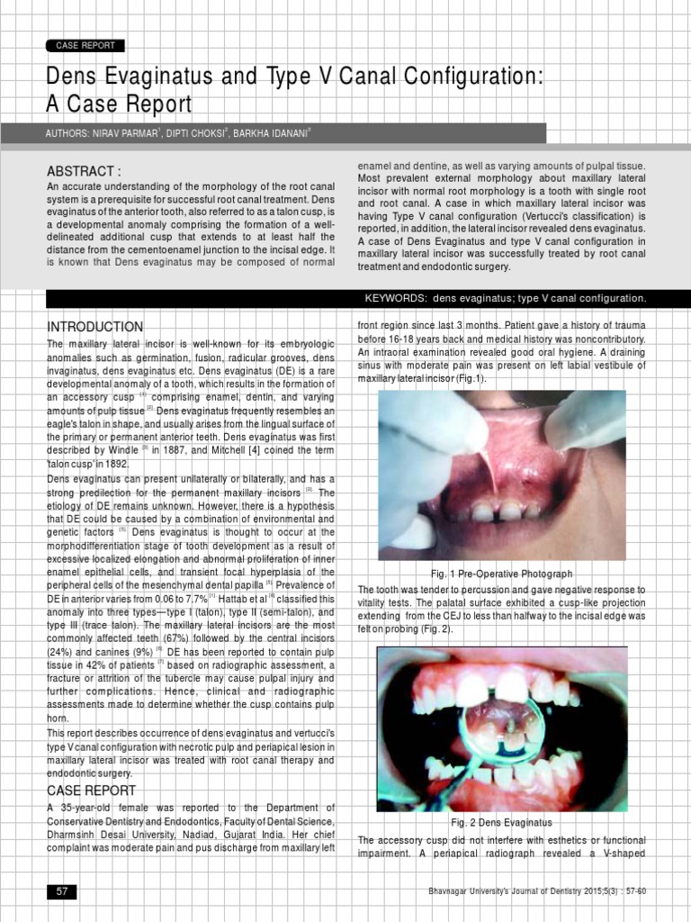 Dens Evaginatus and Type V Canal Configuration: A Case Report | PDF ...