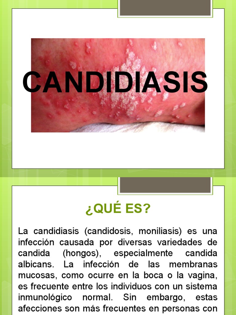 Candidiasis | PDF | Candidiasis | Epidemiología