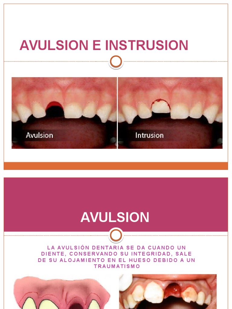 Avulsion e Instrusion | Descargar gratis PDF | Diente humano | Cabeza y ...