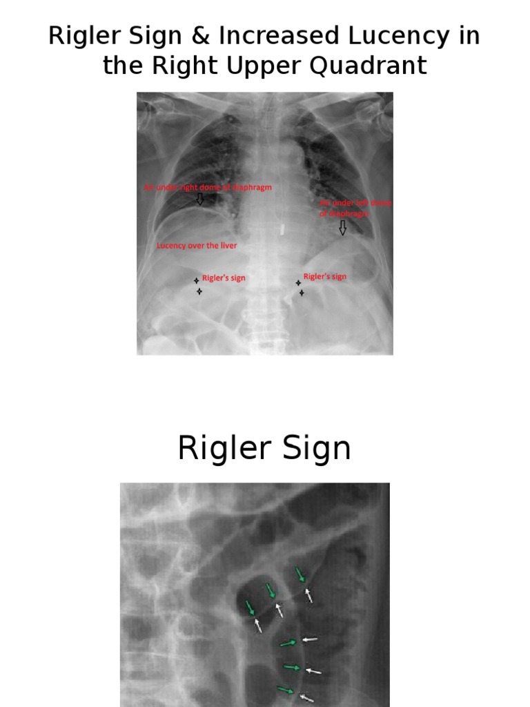 Tanda Tanda Radiologi (Perforasi Gaster) | PDF