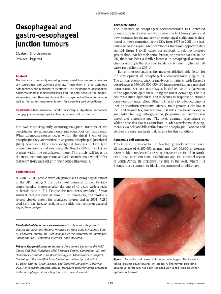 Oesophageal and Gastro Oesophageal Junction Tumours | Esophageal Cancer ...